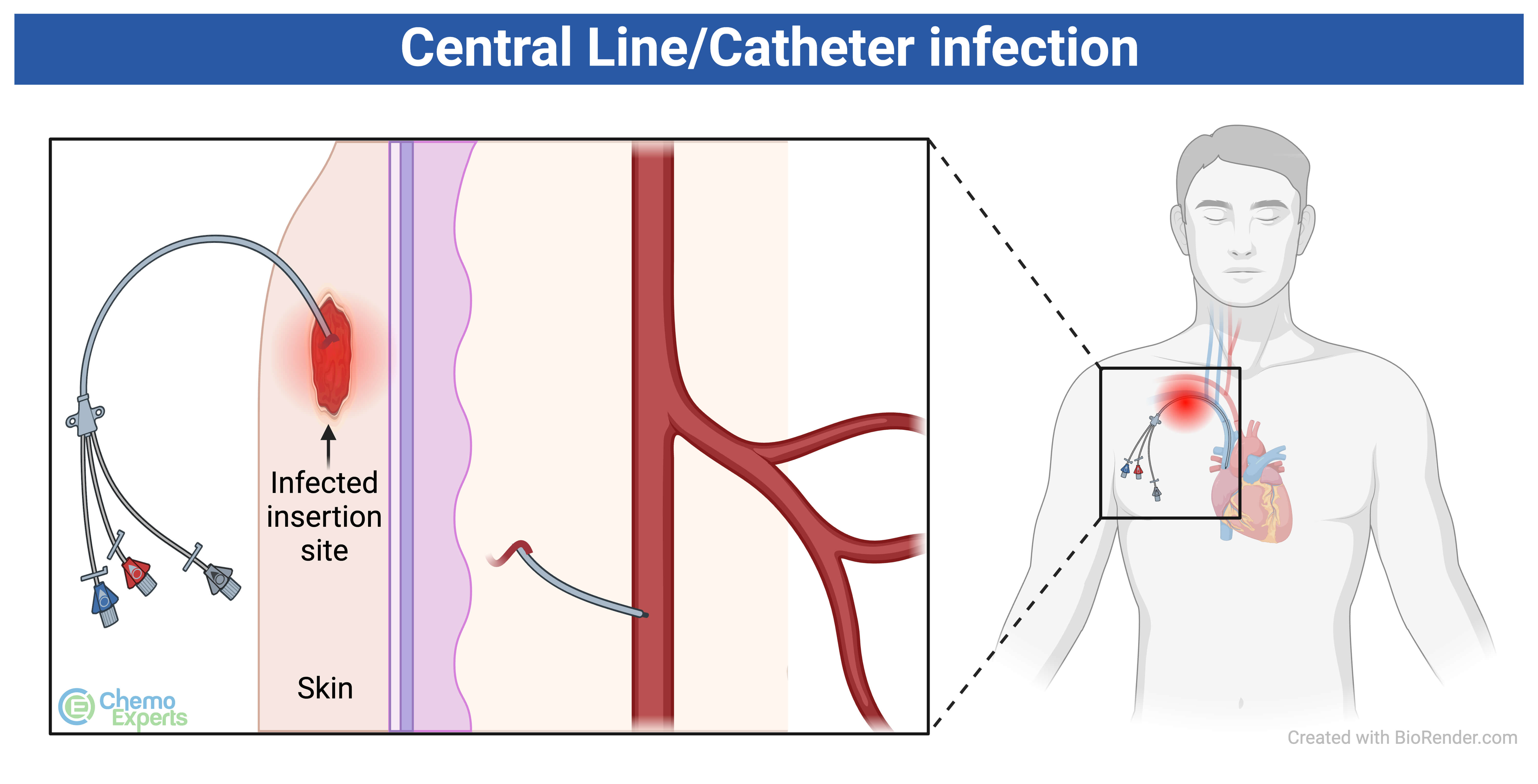 Catheter Line Infection | ChemoExperts